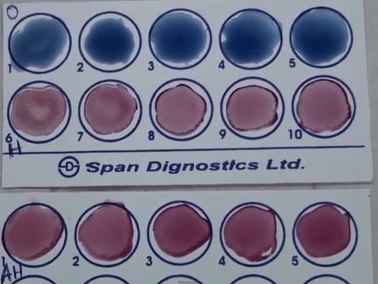 Widal Test Introduction Principle Procedure Interpretation And Limitation widal-test-introduction-principle-procedure-interpretation-and-limitation